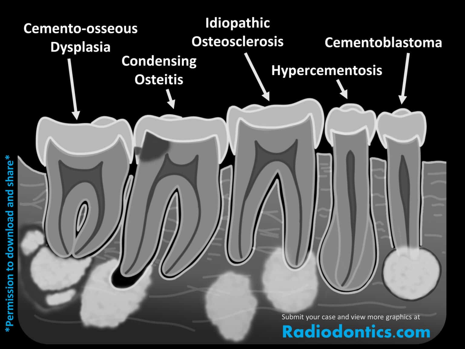 Apical Radiopacities - Radiodontics