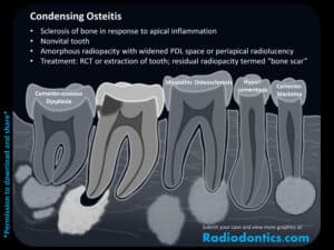 Apical Radiopacities - Radiodontics