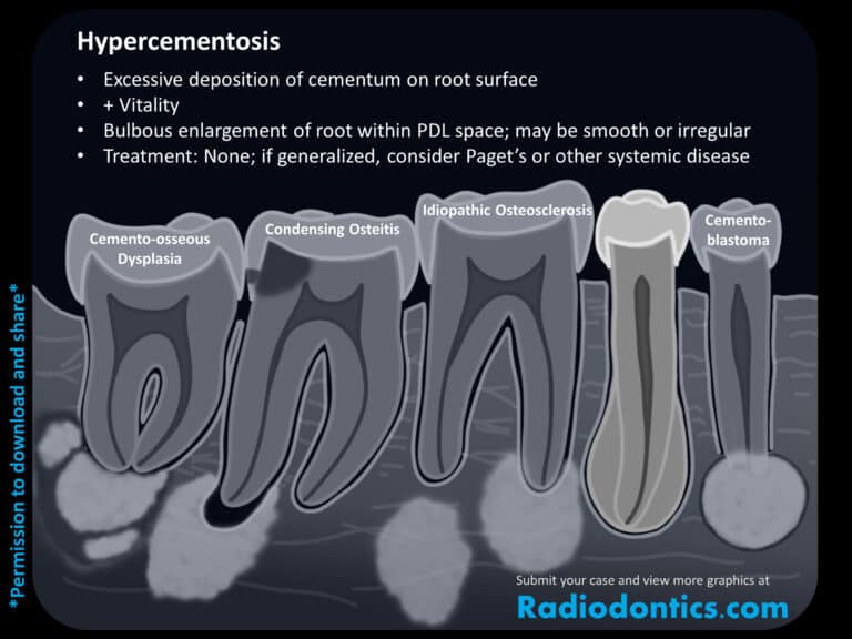 Apical Radiopacities - Radiodontics