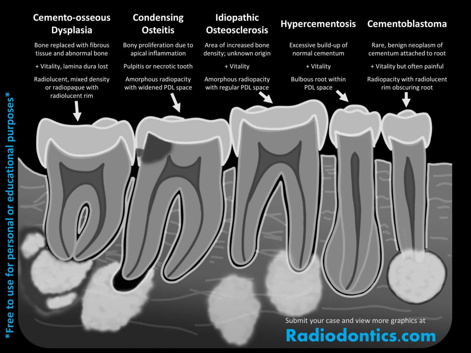 Apical Radiopacities - Radiodontics