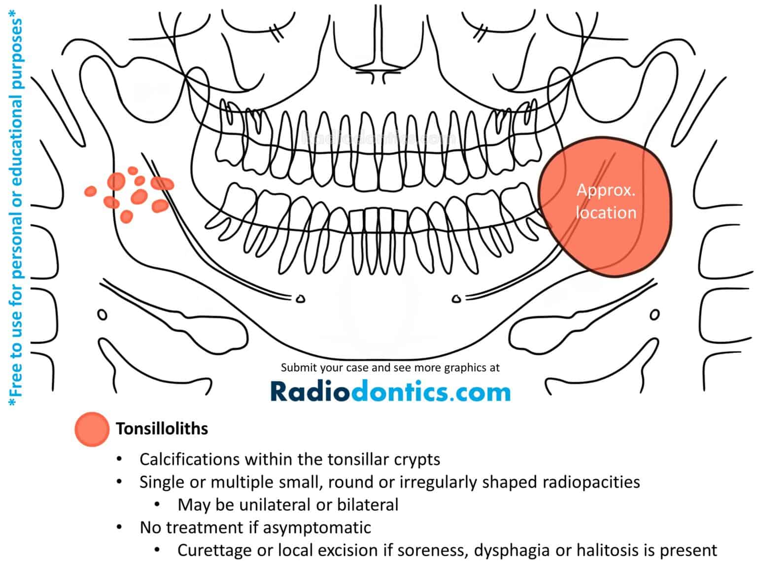 Panoramic Radiopacities - Radiodontics