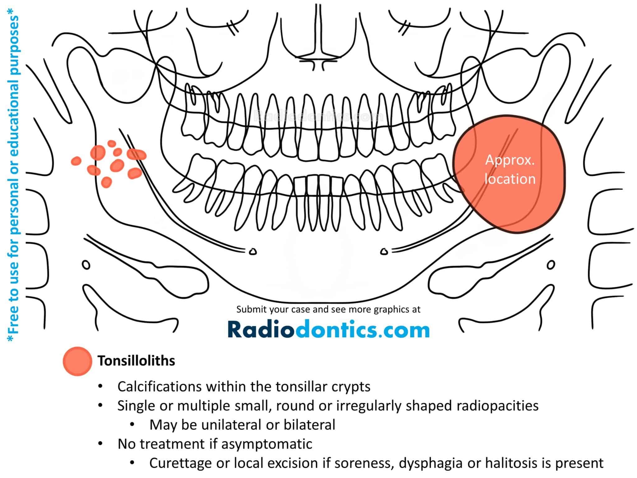 Panoramic Radiopacities - Radiodontics