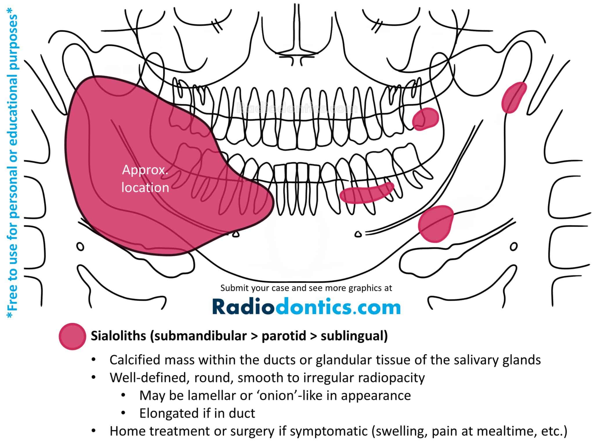 Panoramic Radiopacities - Radiodontics