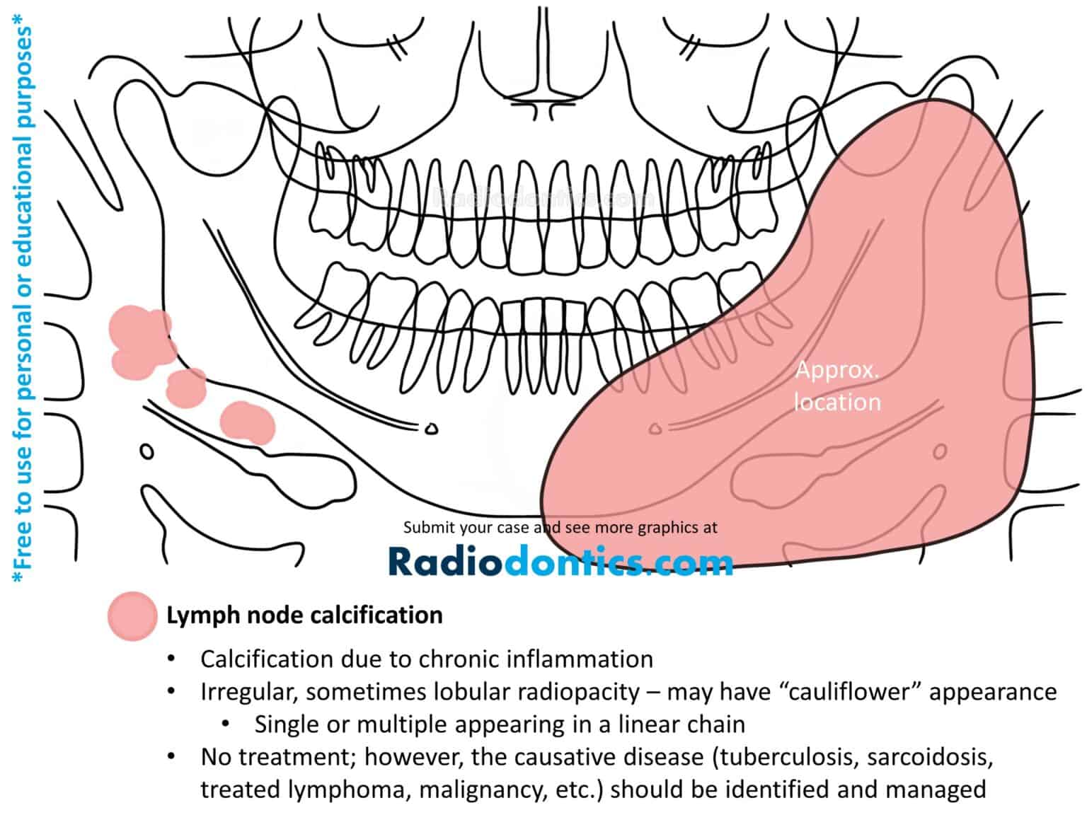 Panoramic Radiopacities - Radiodontics