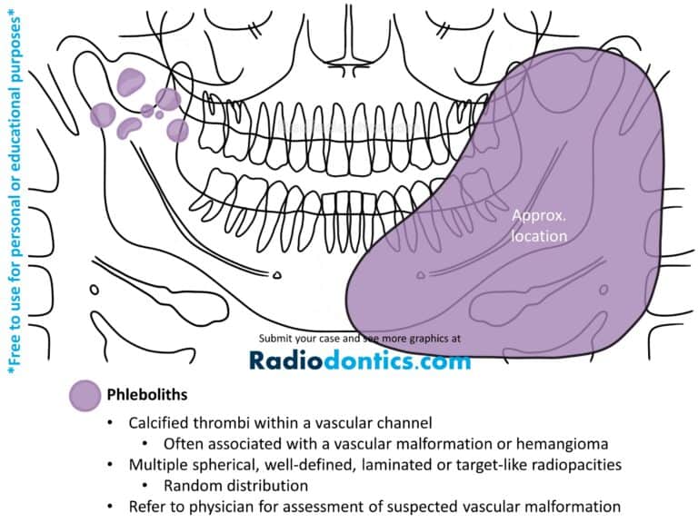 Panoramic Radiopacities - Radiodontics