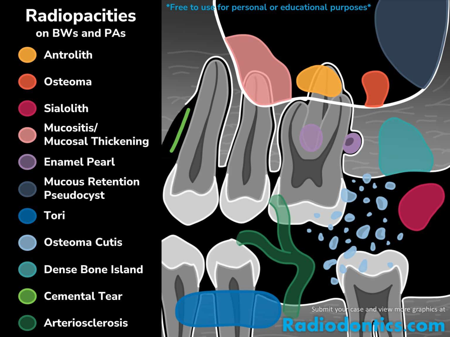 Periapical and Bitewing Radiopacities - Radiodontics