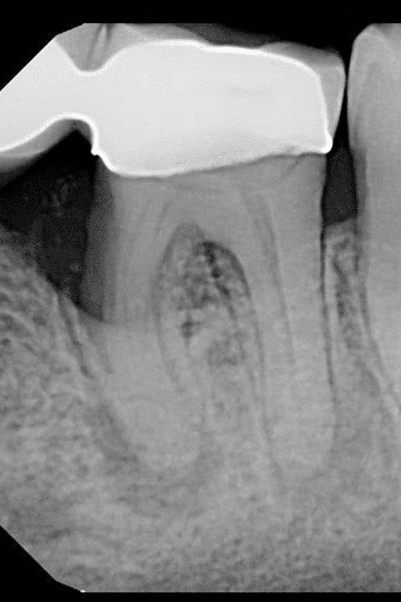Periapical and Bitewing Radiopacities - Radiodontics