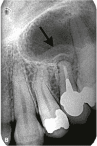 Periapical and Bitewing Radiopacities - Radiodontics
