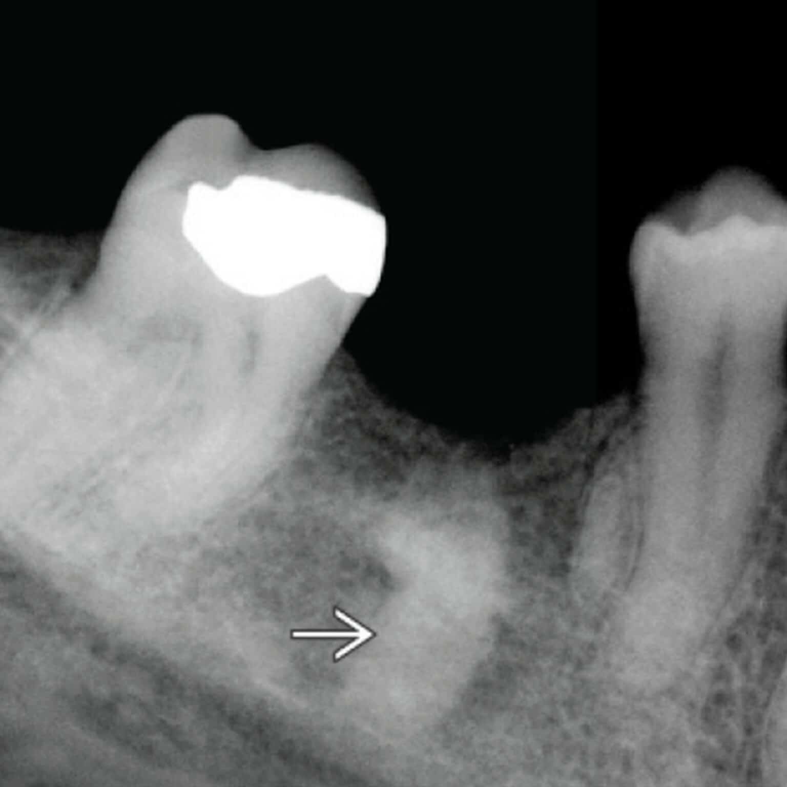 Periapical and Bitewing Radiopacities - Radiodontics