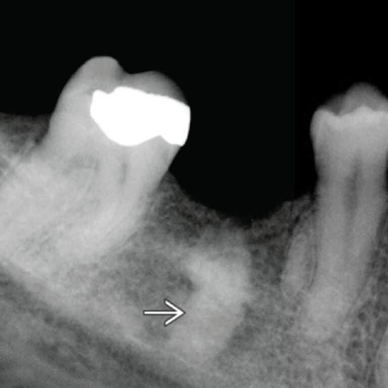 Periapical and Bitewing Radiopacities - Radiodontics