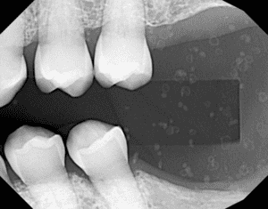 Periapical and Bitewing Radiopacities - Radiodontics