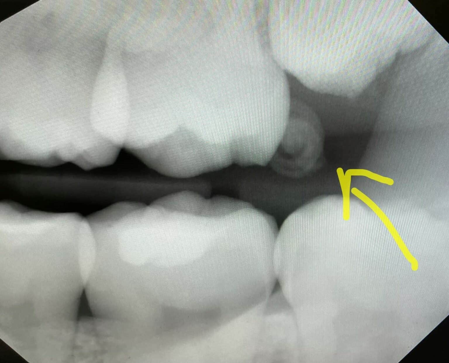 Periapical and Bitewing Radiopacities - Radiodontics