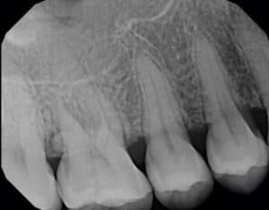 Periapical and Bitewing Radiopacities - Radiodontics