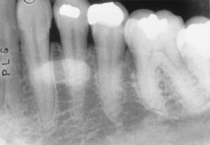 Periapical and Bitewing Radiopacities - Radiodontics